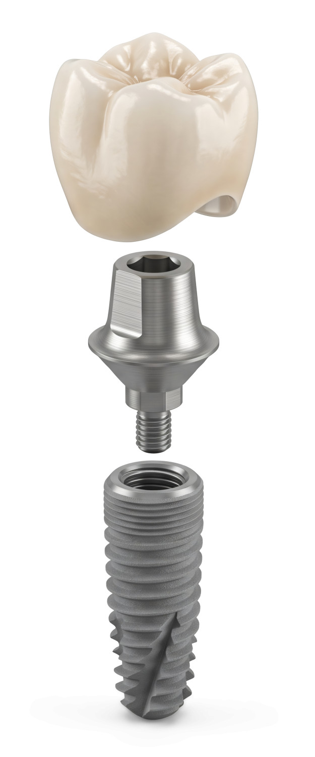 Tooth Implant Presentation Clipart