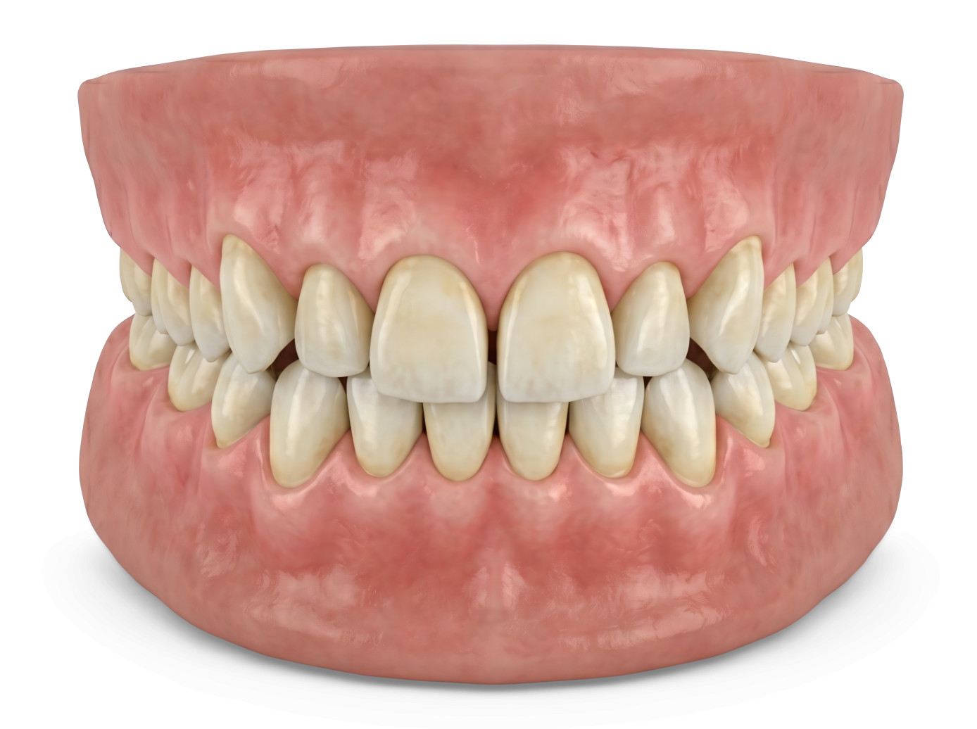 Yellowed Tooth Enamel PPT Clipart